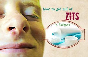 37 Tips How To Get Rid Of Zits On Nose, Lips, Chest, & Scalp Overnight