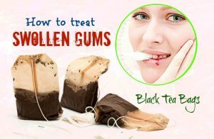 34 Tips How to Treat Swollen Gums around Tooth and Cheek Fast