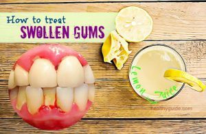 34 Tips How to Treat Swollen Gums around Tooth and Cheek Fast