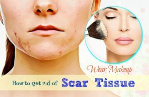 How To Get Rid Of Scar Tissue On Face And Lip- Top 28 Simple Methods