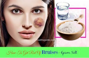 22 Tips How to Get Rid of Bruises on Lips, Face, Shins, and Hands Fast