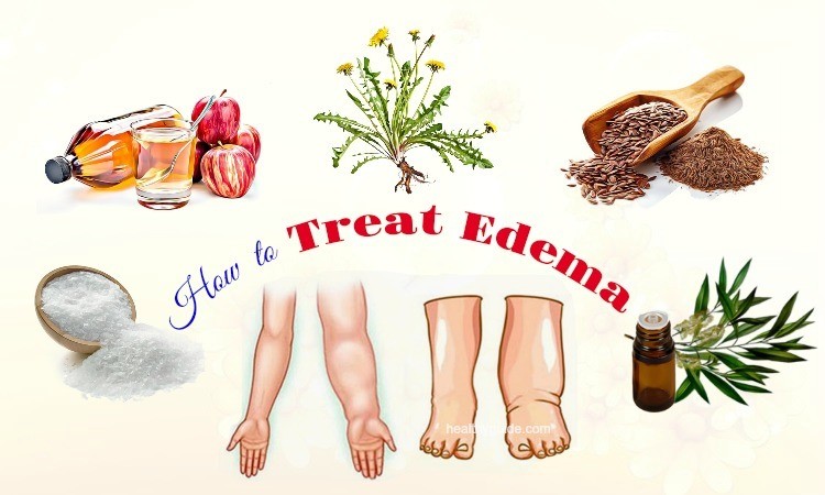 27 Tips How to Treat Edema in Face, Hands, Arms, Feet, Legs, & Knee ...